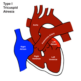 Congenital Heart Diseases – Department of Pediatrics – UW–Madison